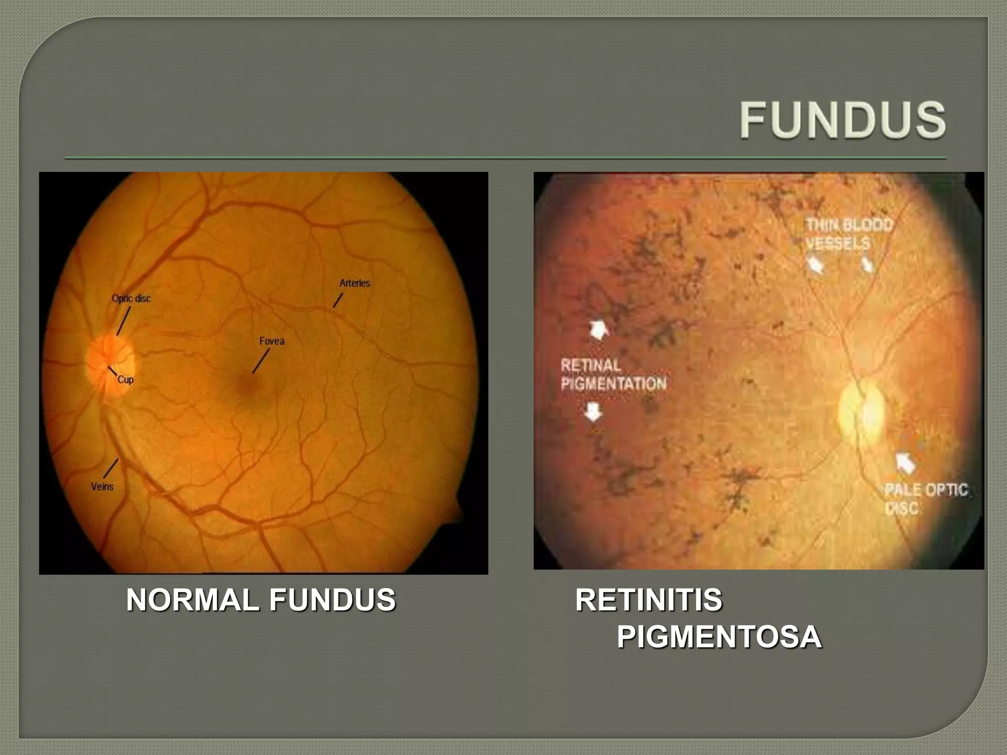Retinitis Pigmentosa.pptx