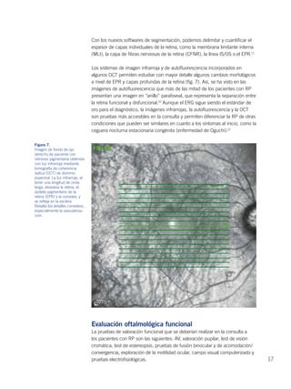 RETINITIS PIGMENTOSA.pdf