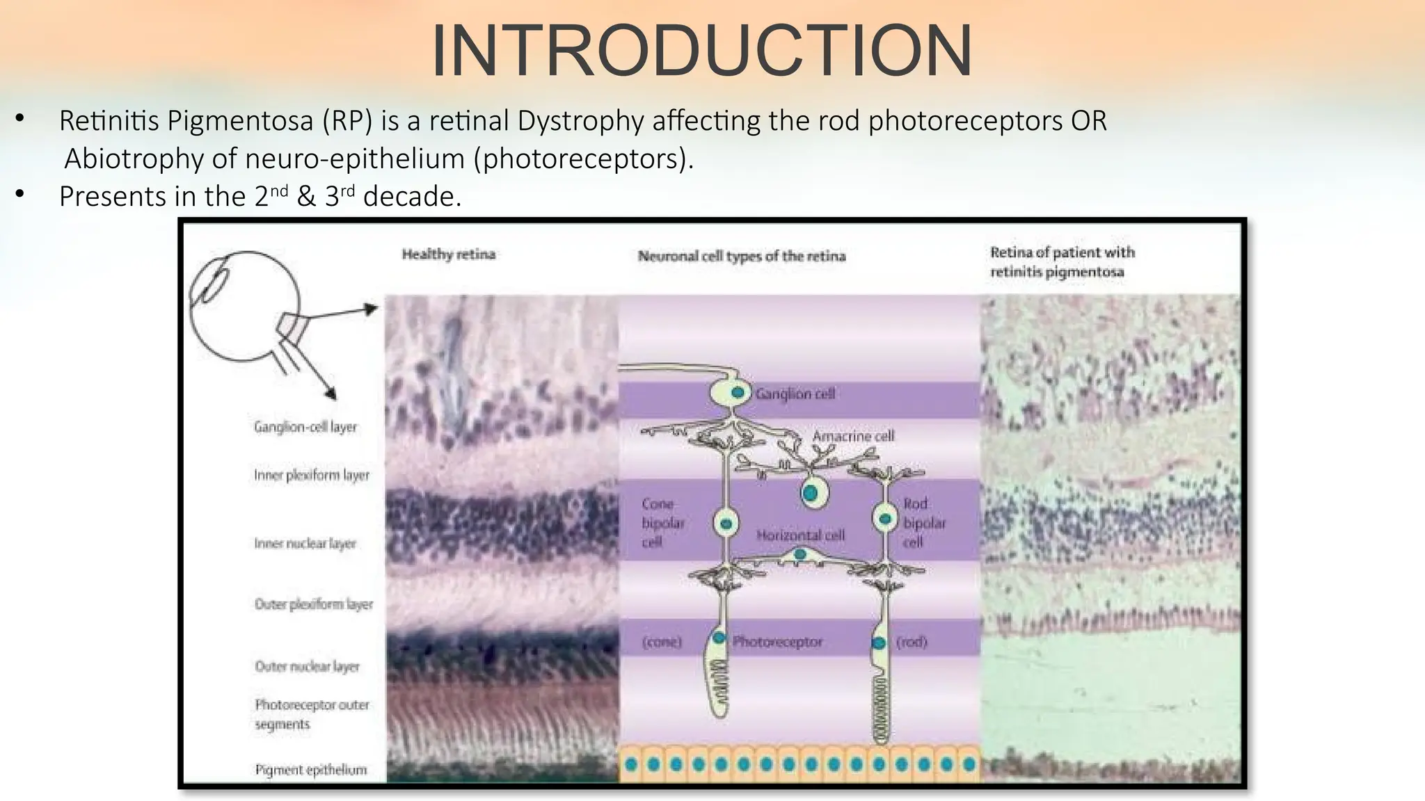Approach to a case of Retinitis Pigmentosa.pptx