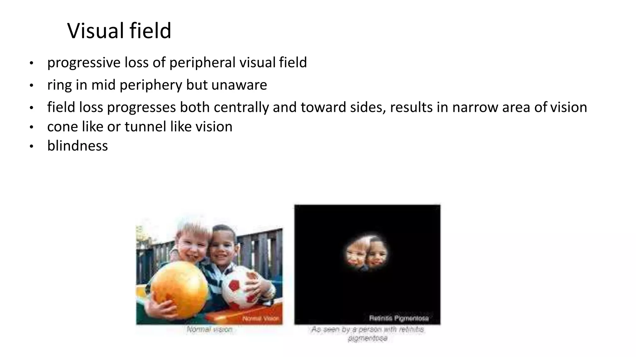 Retinitis pigmentosa and allied disorders | PPTX | Eye and Vision ...