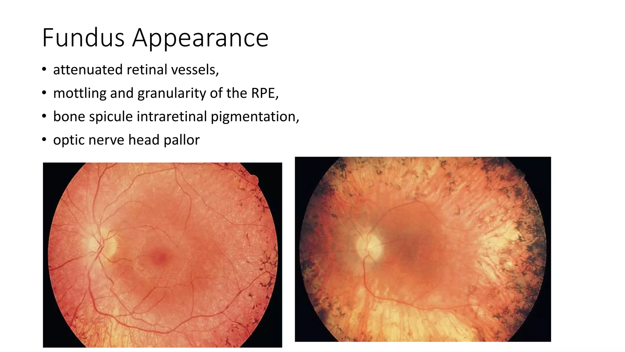 Retinitis pigmentosa and allied disorders | PPTX | Eye and Vision ...