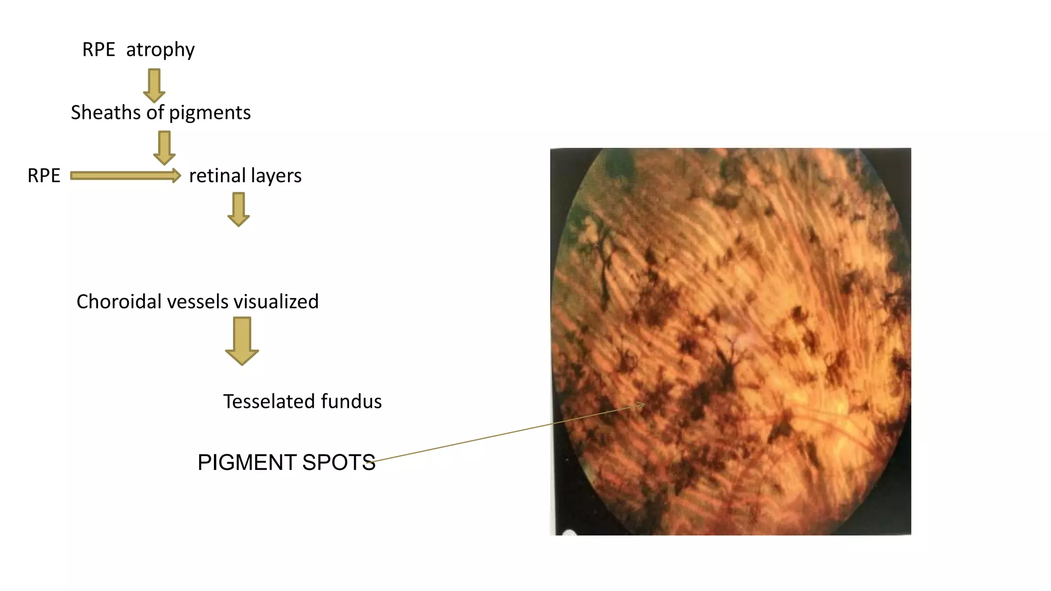 Retinitis pigmentosa and allied disorders | PPTX | Eye and Vision ...