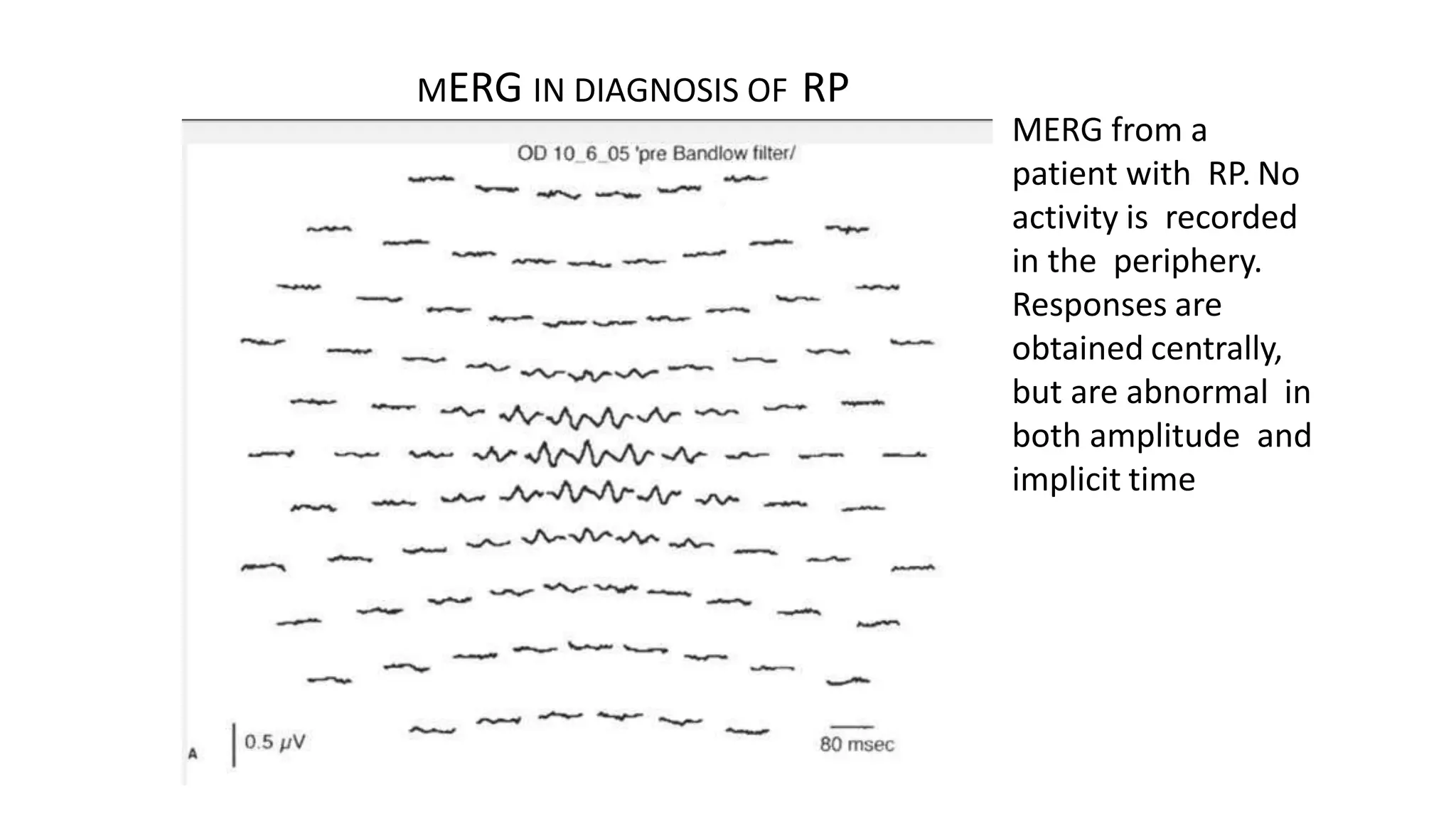 Retinitis pigmentosa and allied disorders | PPTX | Eye and Vision ...
