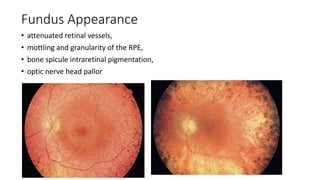 Retinitis pigmentosa and allied disorders | PPTX
