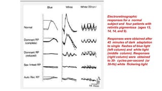 Retinitis pigmentosa and allied disorders | PPTX