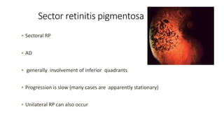 Retinitis pigmentosa and allied disorders | PPTX