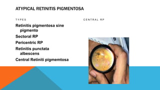 Retinitis Pigmentosa and vitreous by Dr H N Sowbhagya.pptx