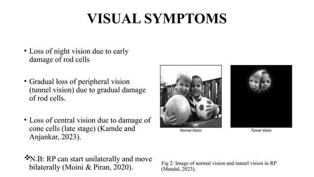 RETINITIS PIGMENTOSA Seminar Presentation | PPTX | Eye and Vision ...