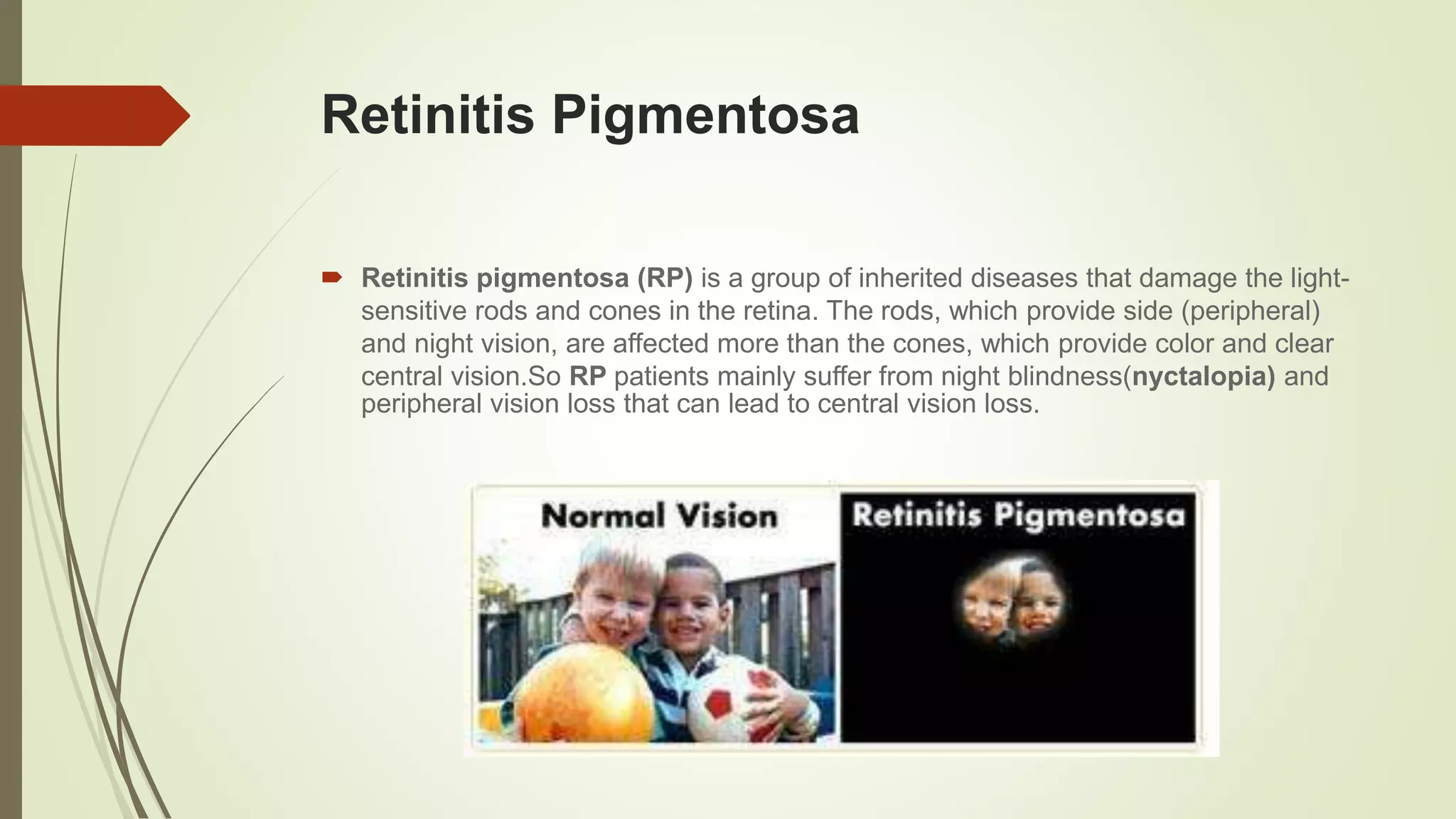 Retinitis pigmentosa ppt | PPTX