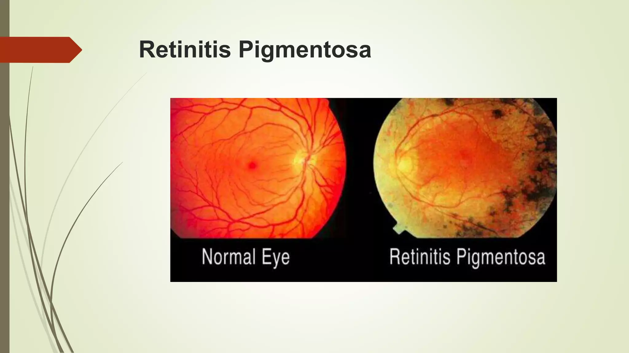 Retinitis pigmentosa ppt | PPTX