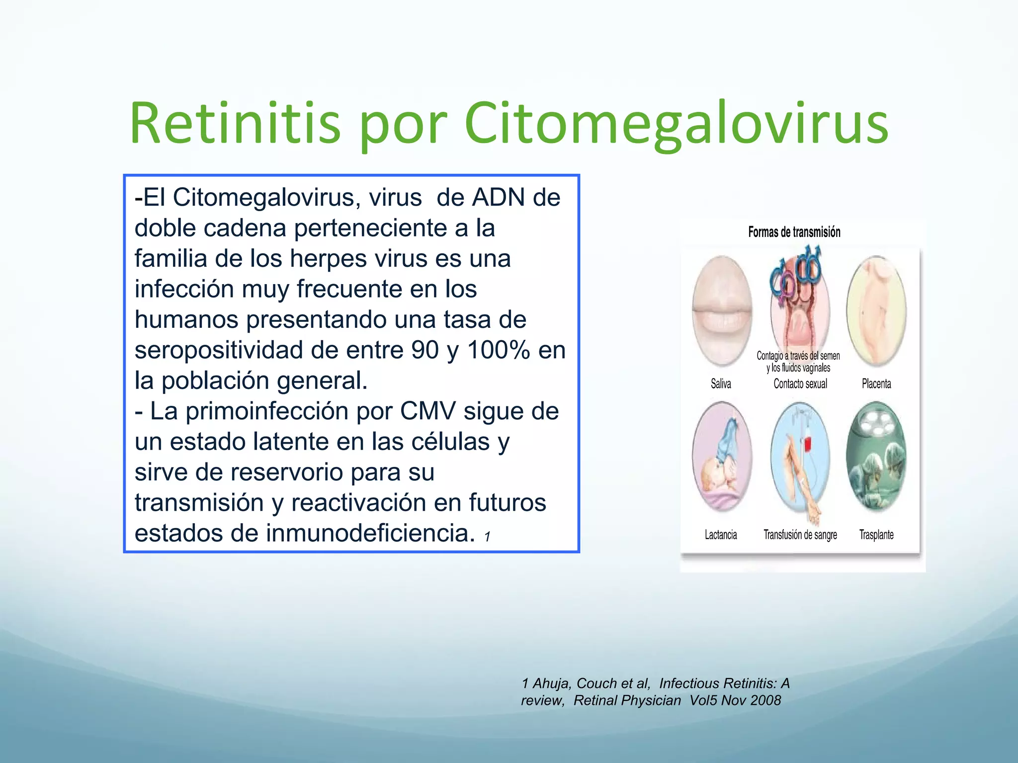 Retinitis por citomegalovirus | PPT