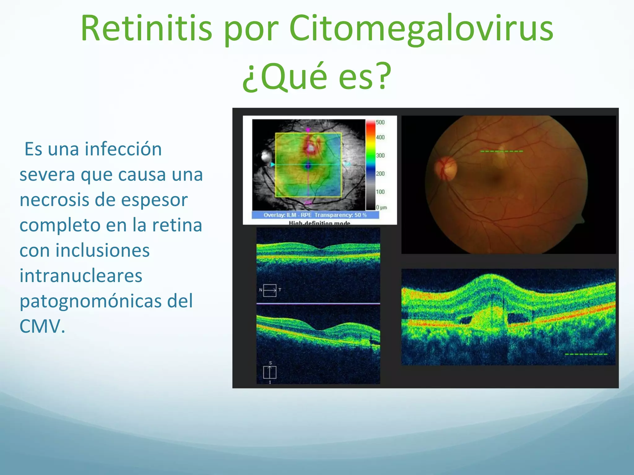 Retinitis por citomegalovirus | PPT