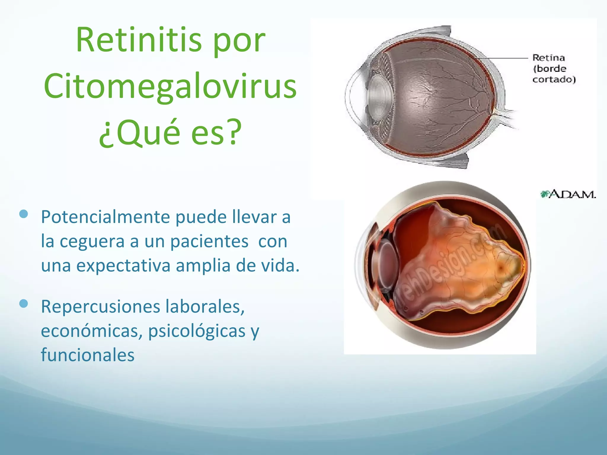 Retinitis por citomegalovirus | PPT