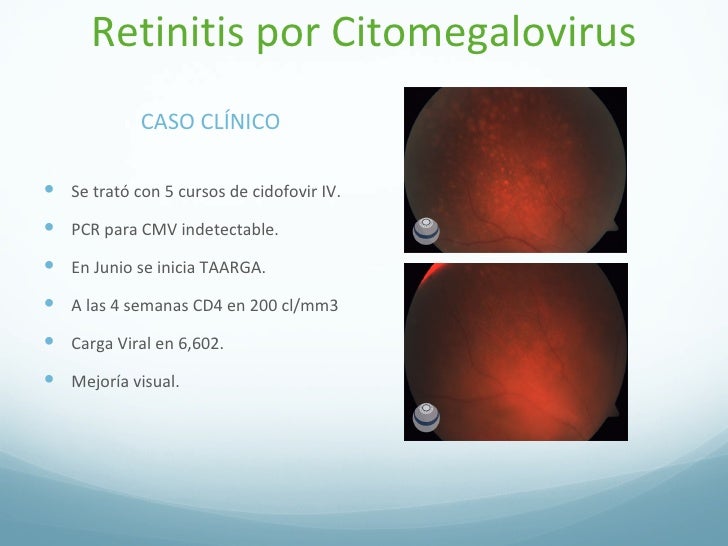 Retinitis por citomegalovirus