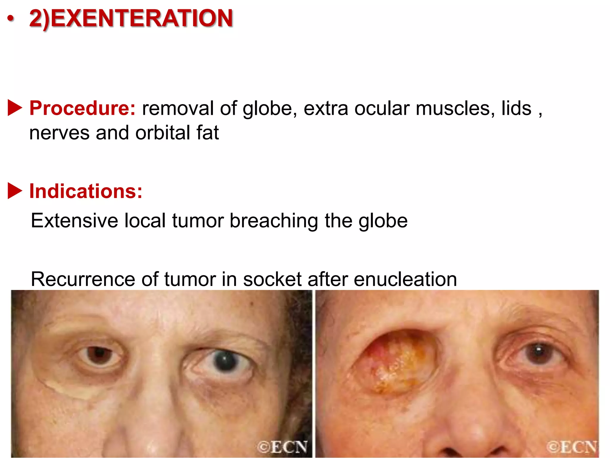 Retinoblastoma | PPTX