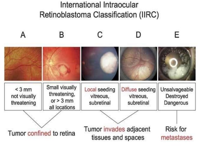 Retinoblastoma | PPTX | Eye and Vision Conditions | Diseases and Conditions