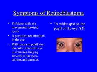 Retinoblastoma | PPT