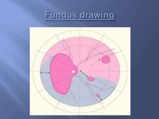 Retinoblastoma Drawing