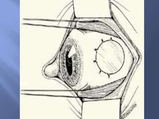 Retinoblastoma Drawing
