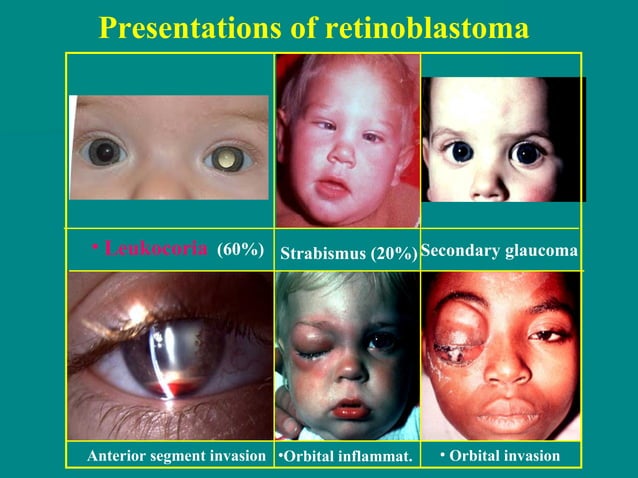 Retinoblastoma, brief overview, June 2013 | PPT