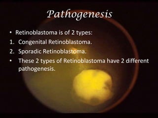 Retinoblastoma: A Beginner's Guide.... | PPT