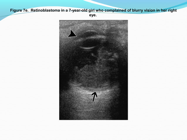 Retinoblastoma | PPT