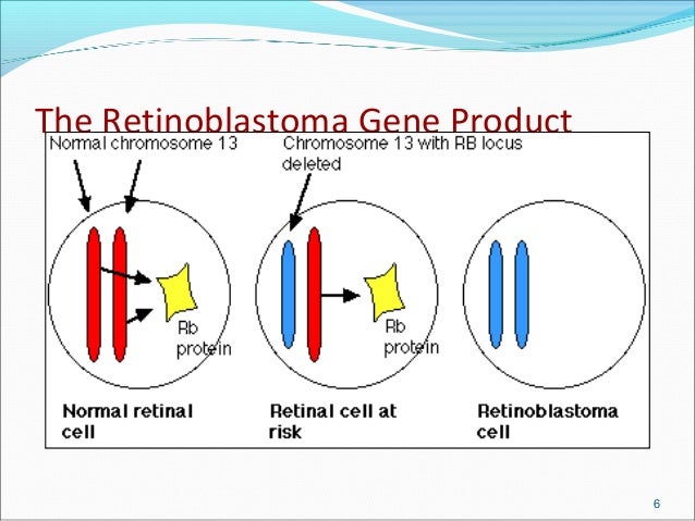 Retinoblastoma