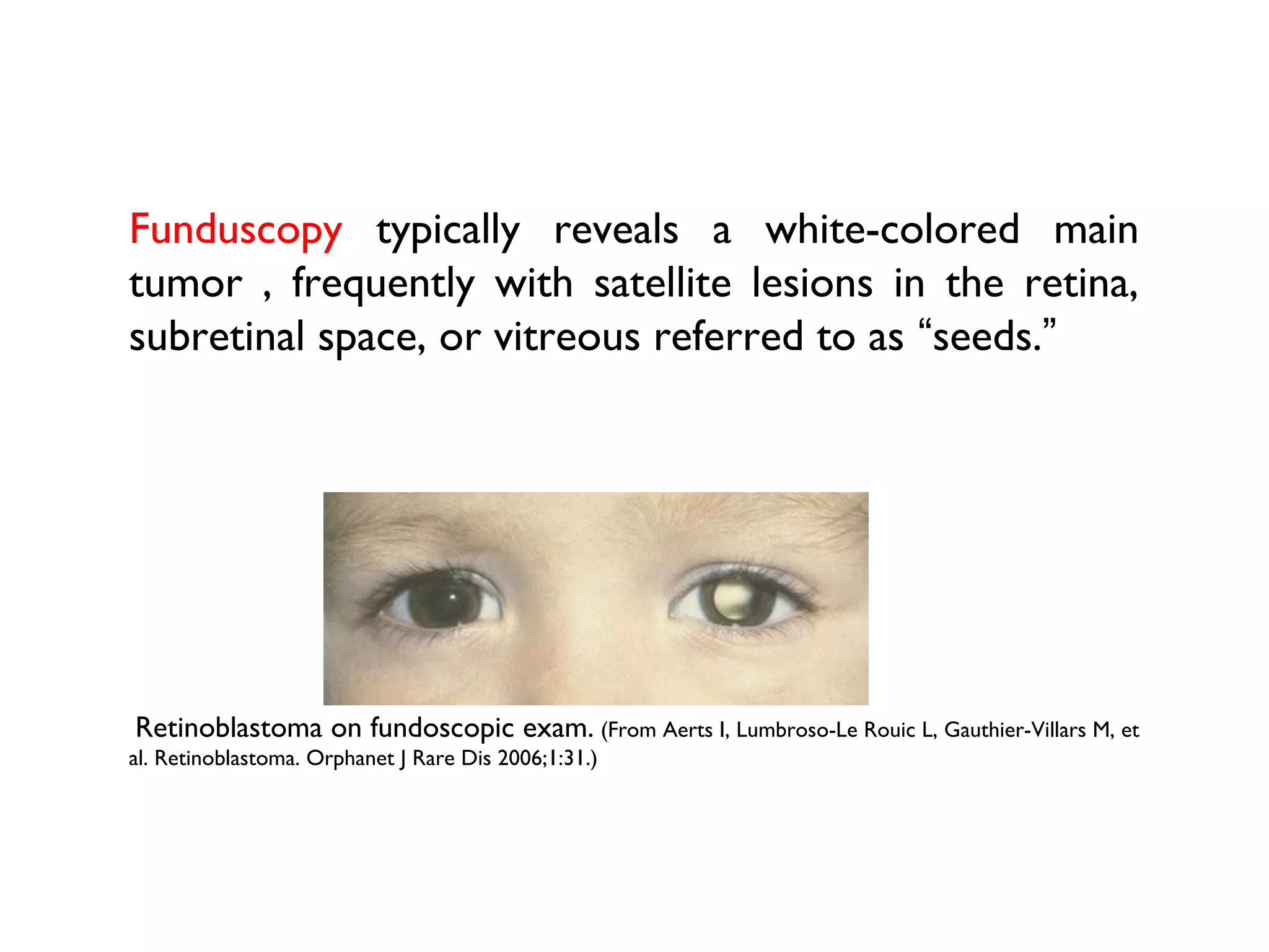 Retinoblastoma | PPT