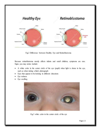 Retinoblastoma | PDF