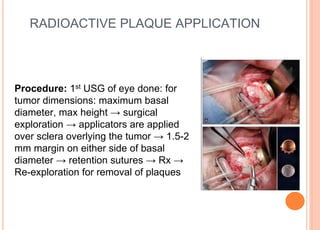 Retinoblastoma | PPTX