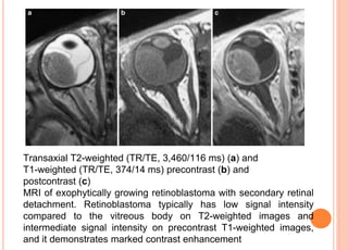 Retinoblastoma | PPTX
