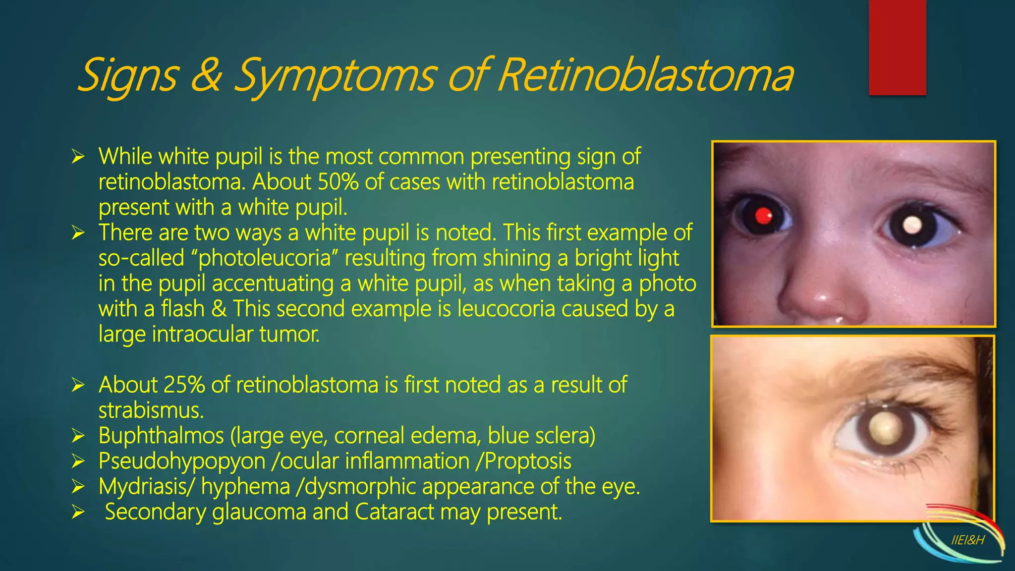 Retinoblastoma | PPTX