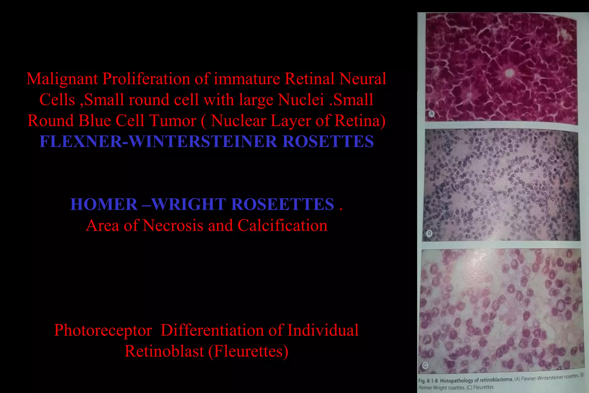 Retinoblastoma | PPT