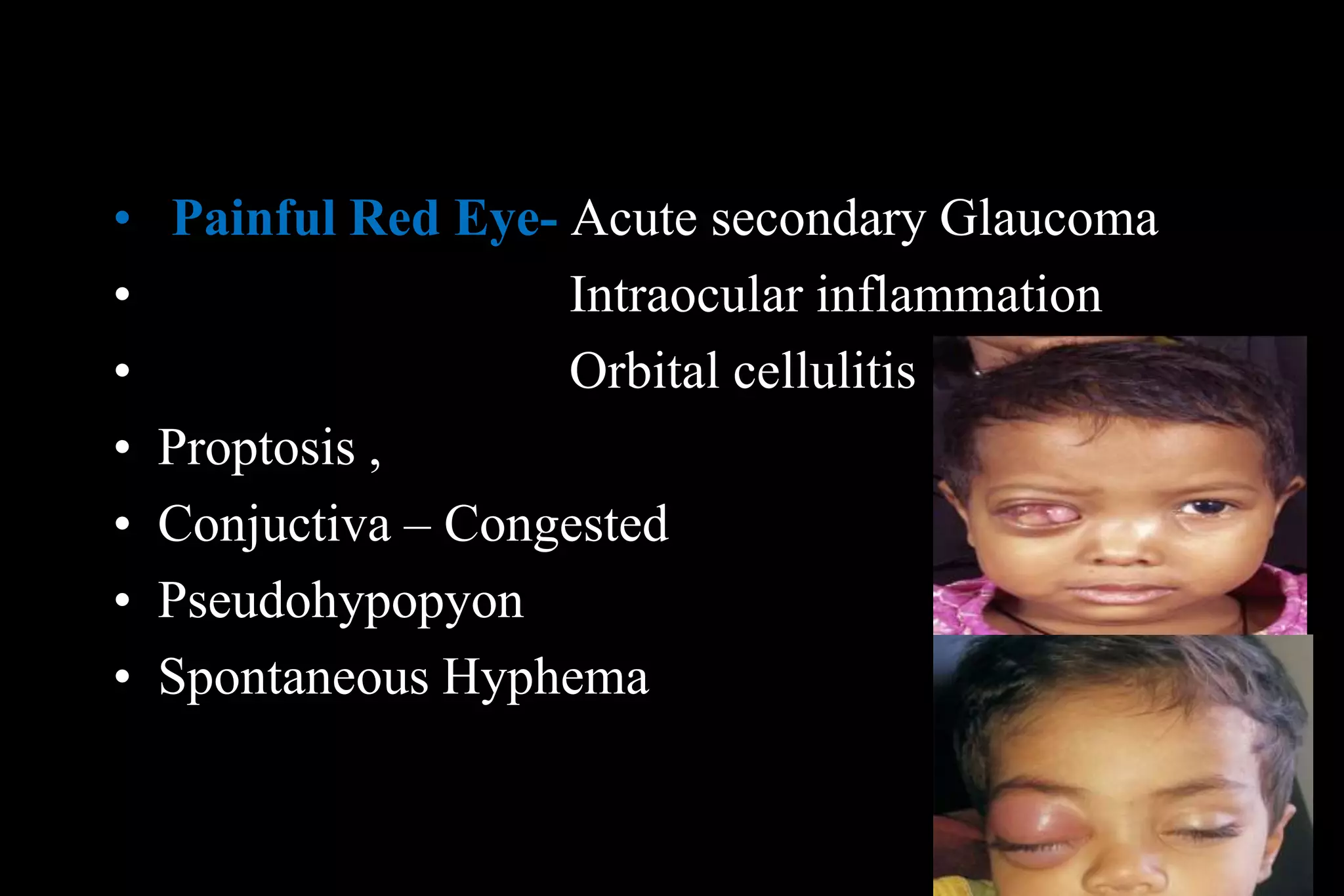 Retinoblastoma | PPT