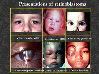 Retinoblastoma.pptx