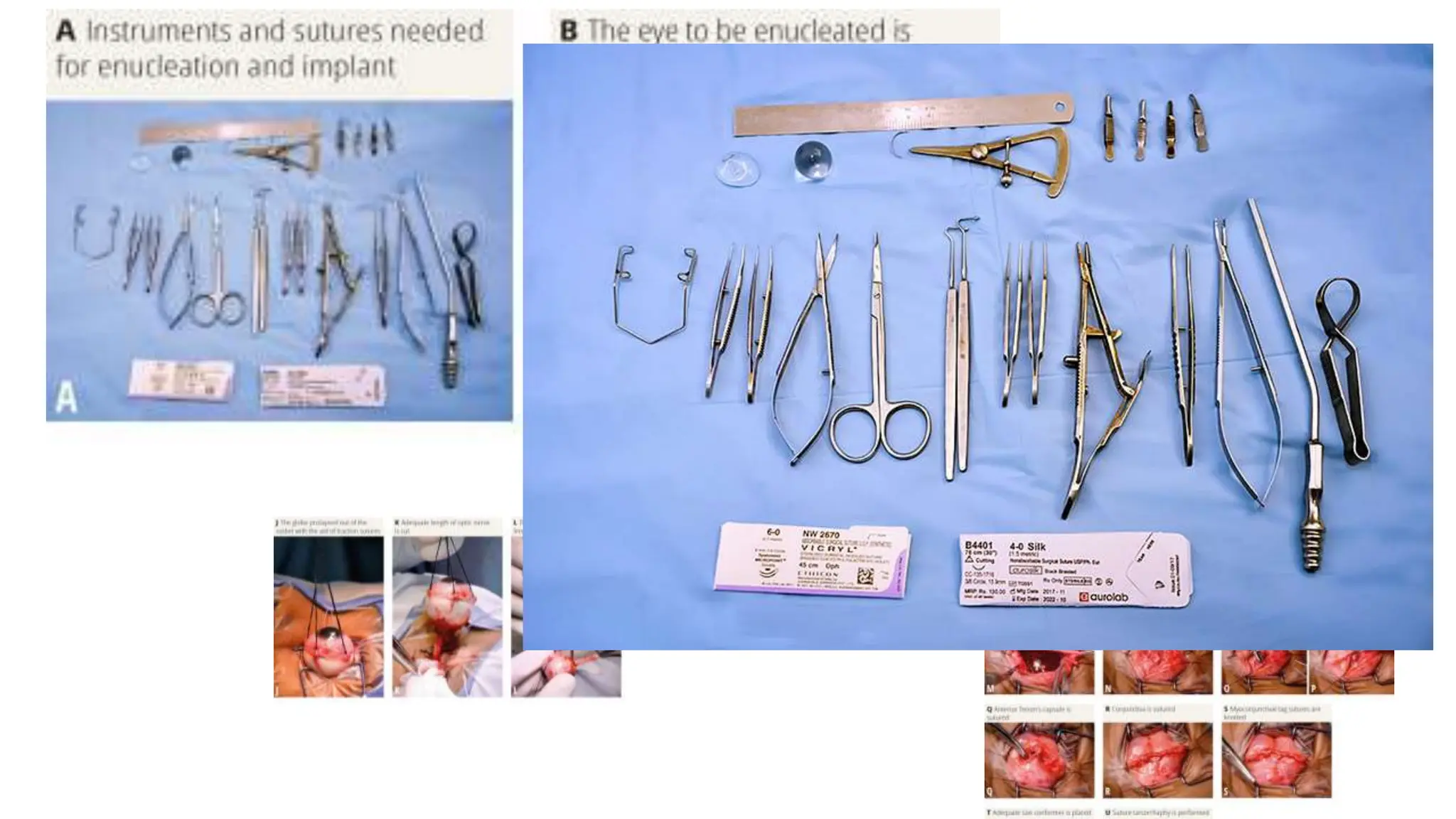 Retinoblastoma-ENUCLEATION A STEP BY STEP APPROACH.pptx