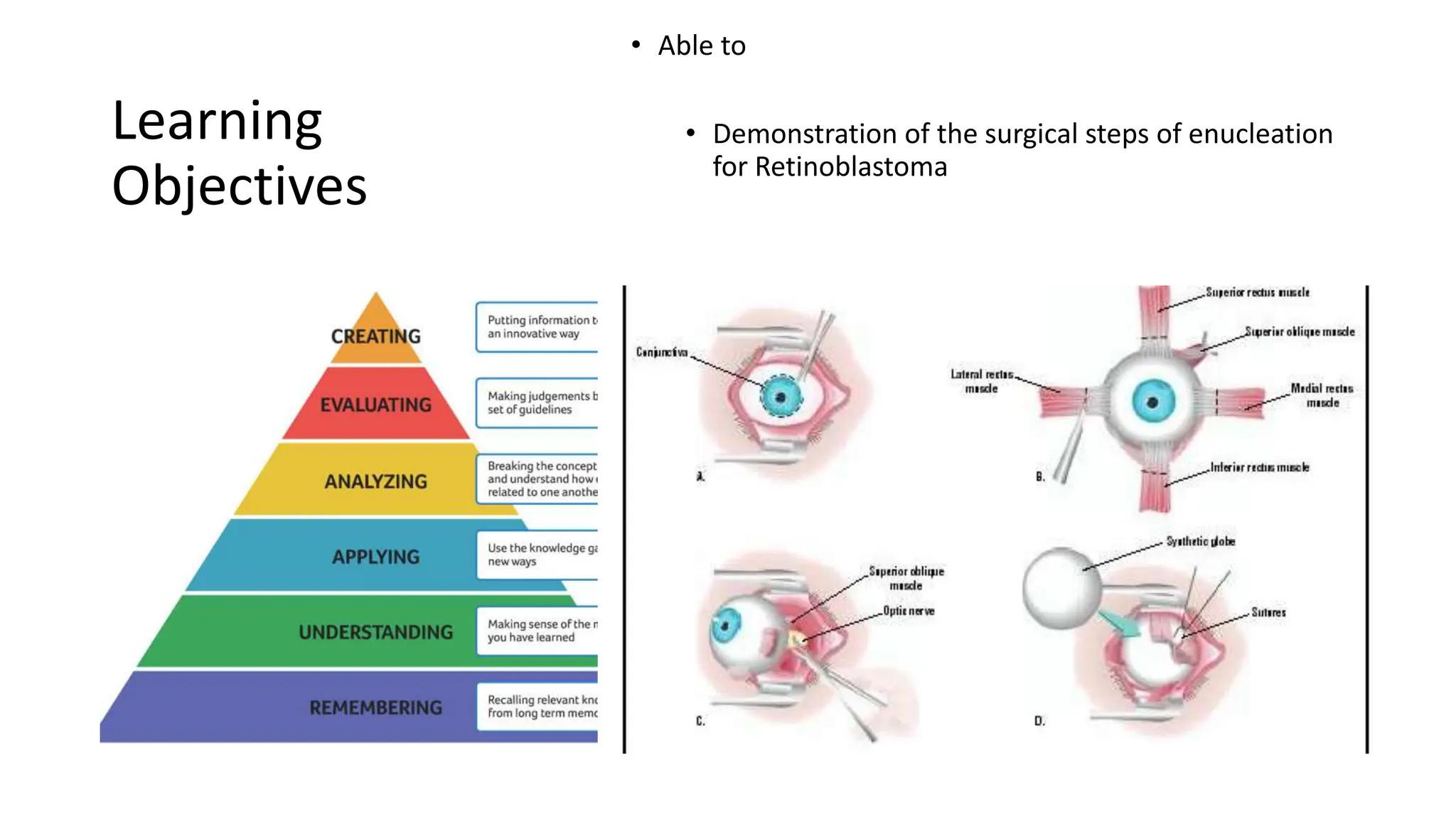 Retinoblastoma-ENUCLEATION A STEP BY STEP APPROACH.pptx
