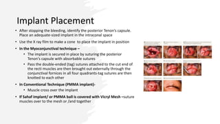 Retinoblastoma-ENUCLEATION A STEP BY STEP APPROACH.pptx