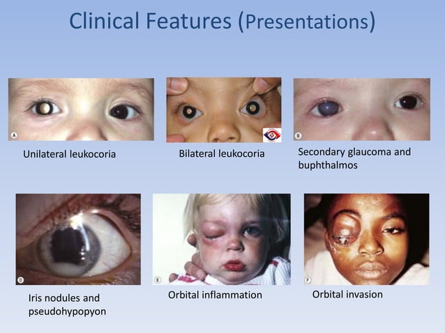 Retinoblastoma | PDF | Eye and Vision Conditions | Diseases and Conditions