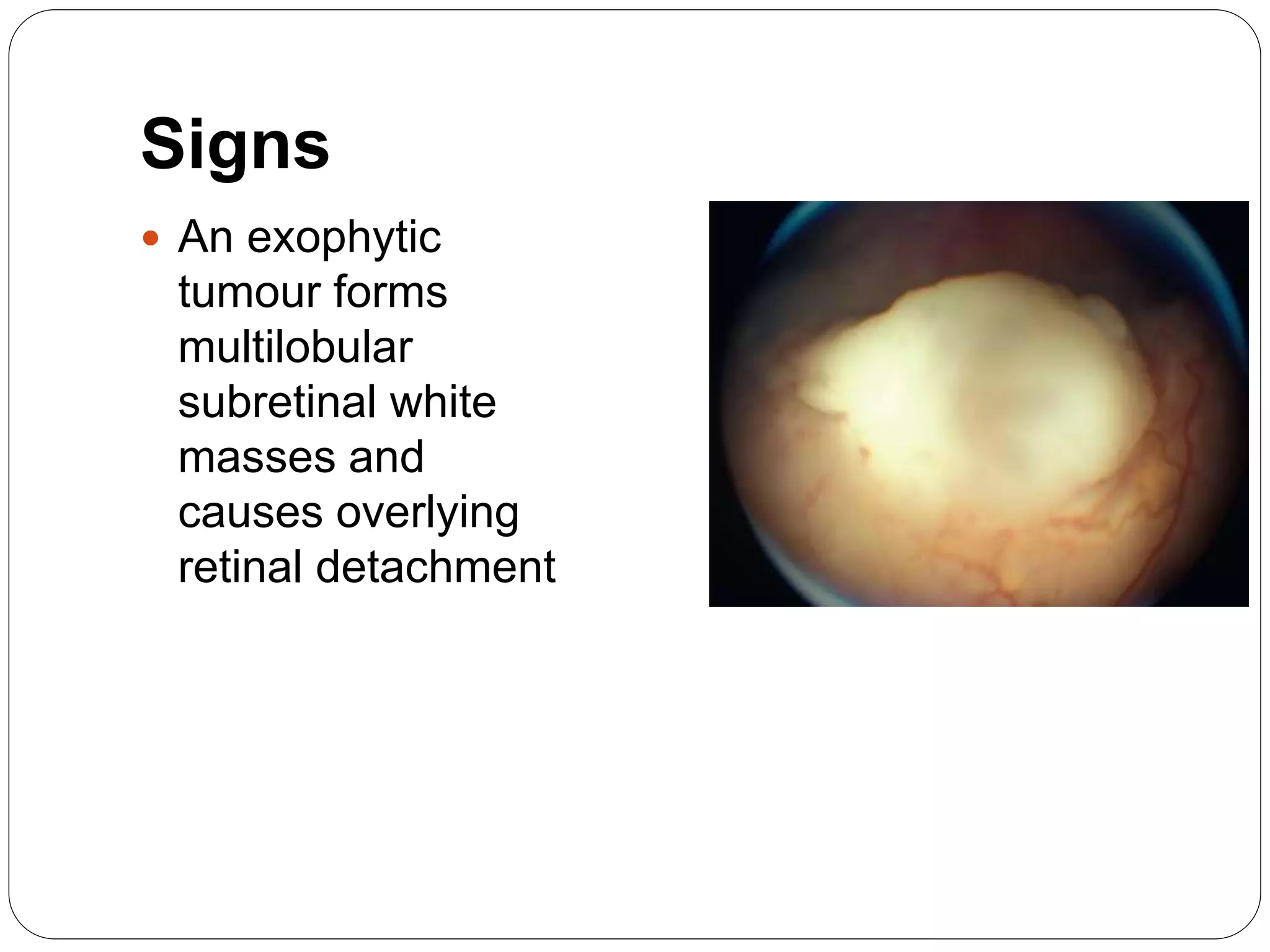 retinoblastoma 2.pptx
