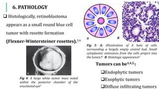 RETINOBLASTOMA 3.pdf