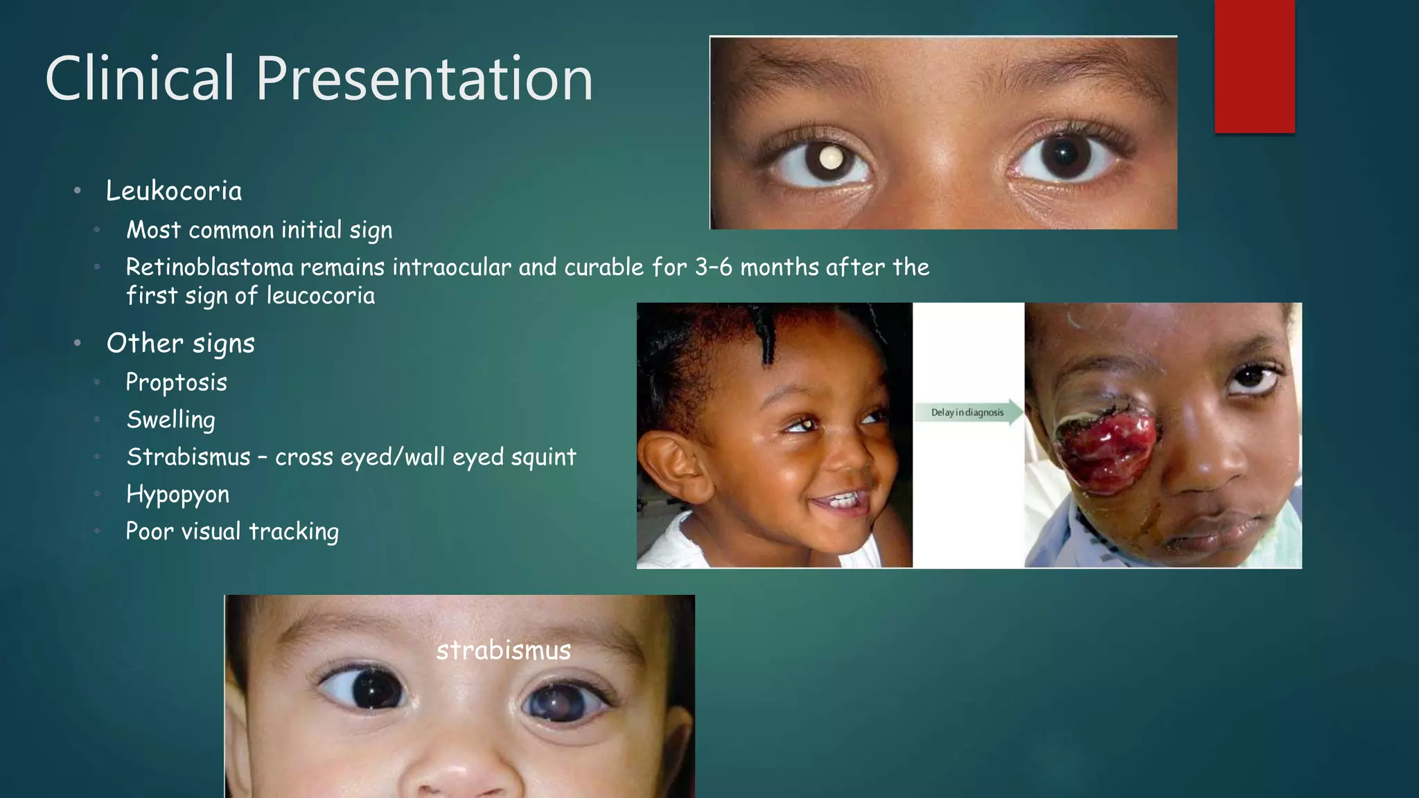 Retinoblastoma 7th | PPT
