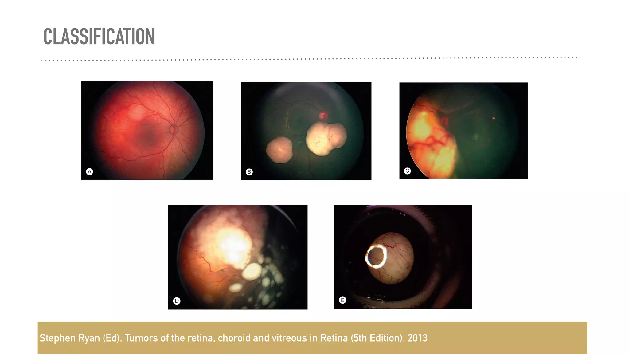 Retinoblastoma, an overview | PDF