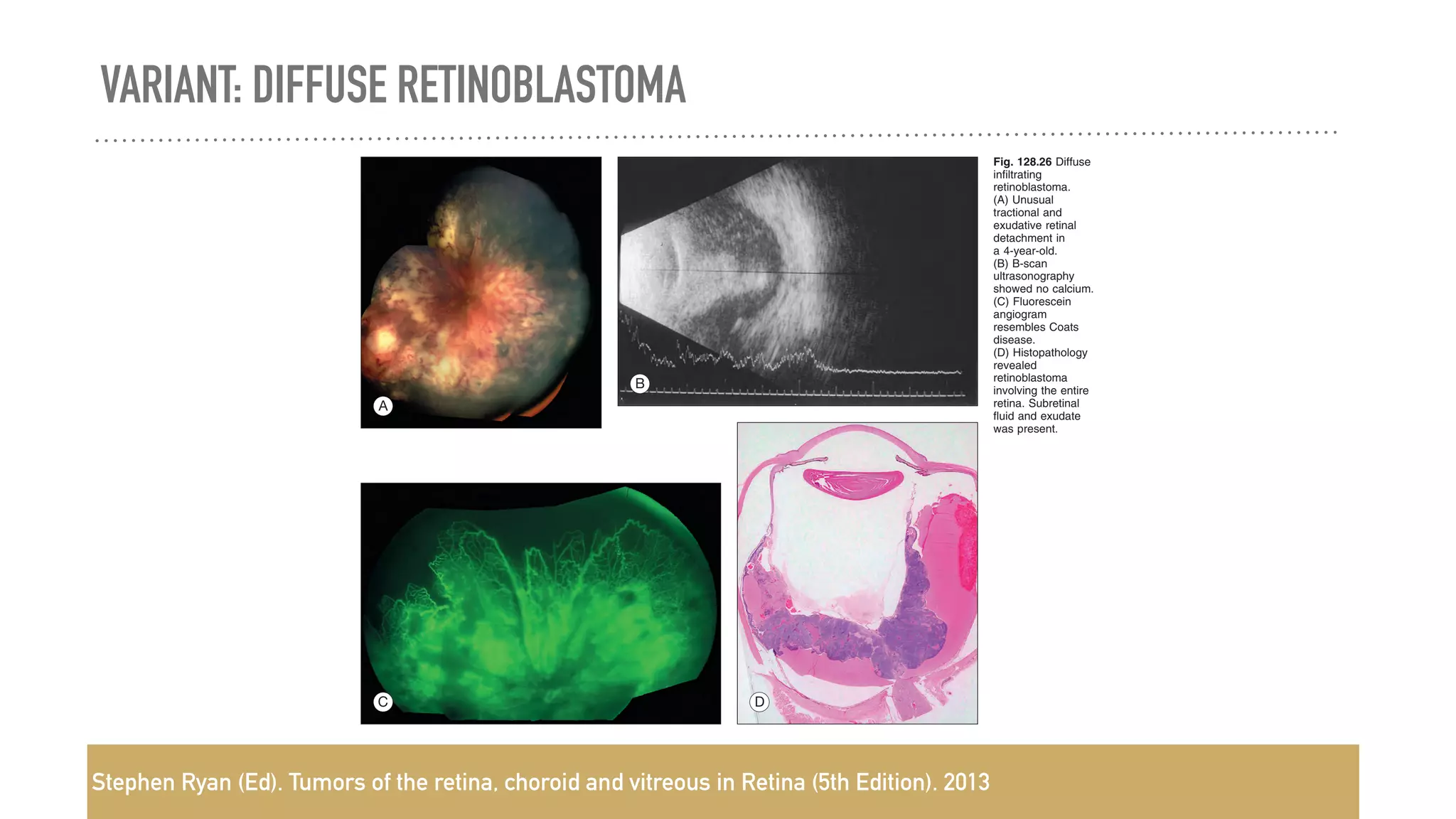 Retinoblastoma, an overview | PDF