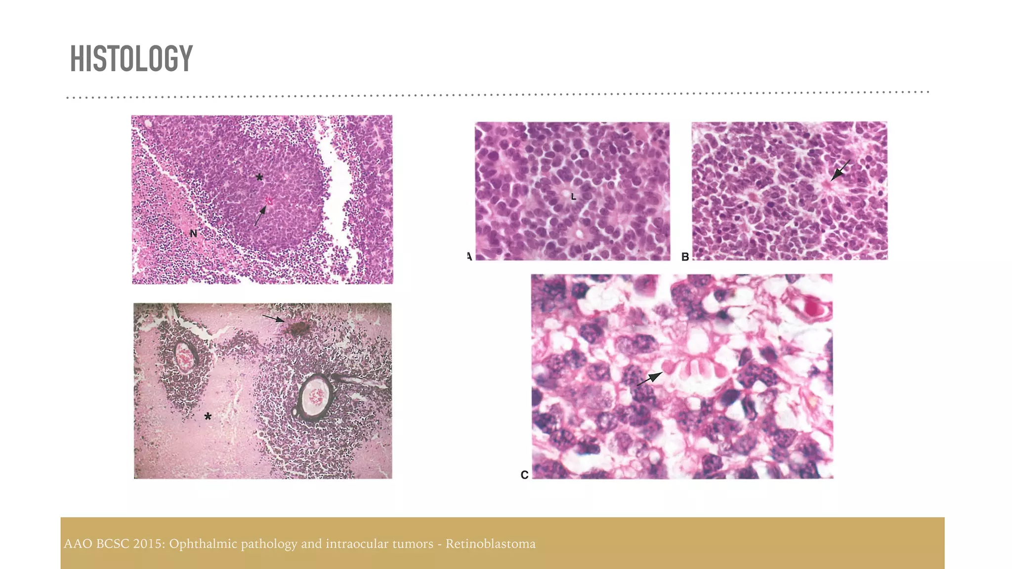 Retinoblastoma, an overview | PDF