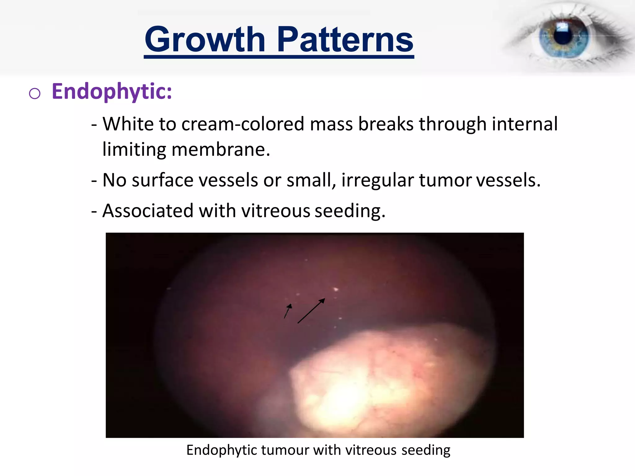 Retinoblastoma | PPTX