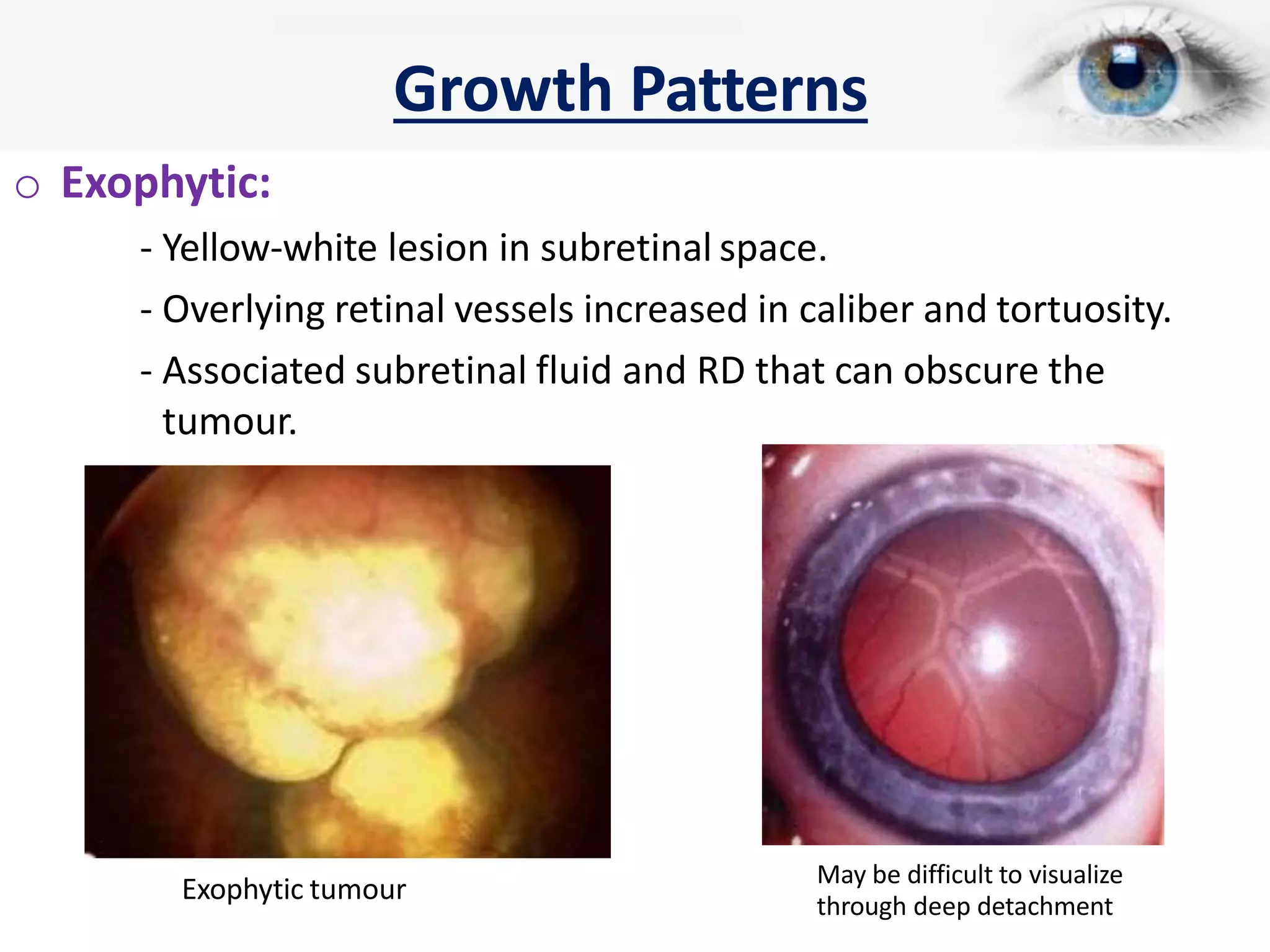 Retinoblastoma | PPTX
