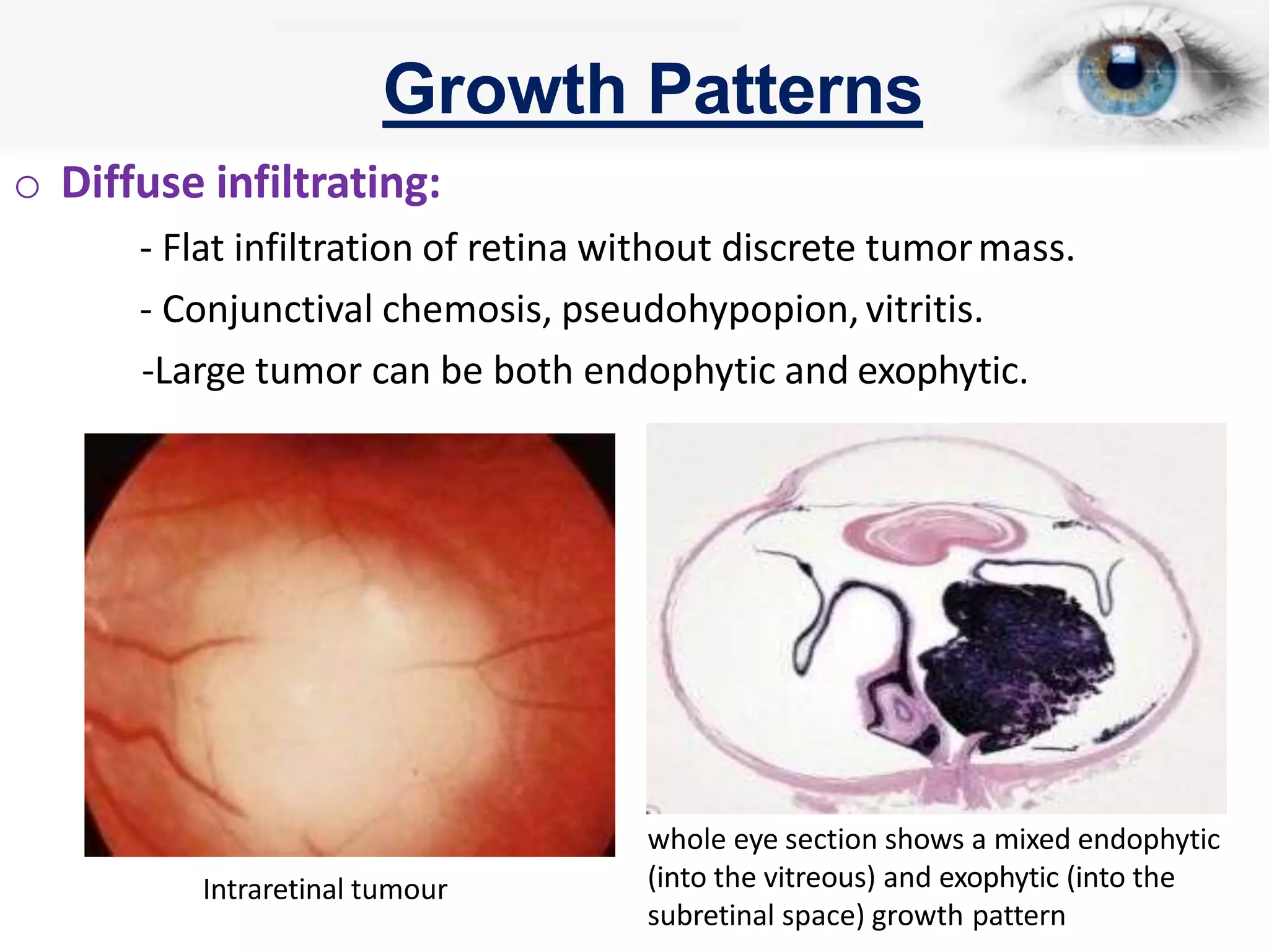 Retinoblastoma | PPTX