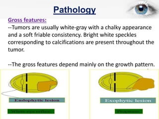Retinoblastoma | PPTX