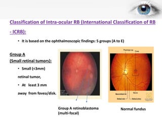Retinoblastoma | PPTX